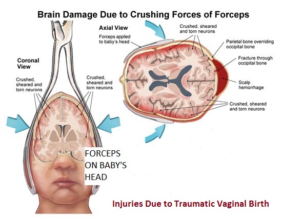Forceps Delivery Injuries What Is Birth Trauma?